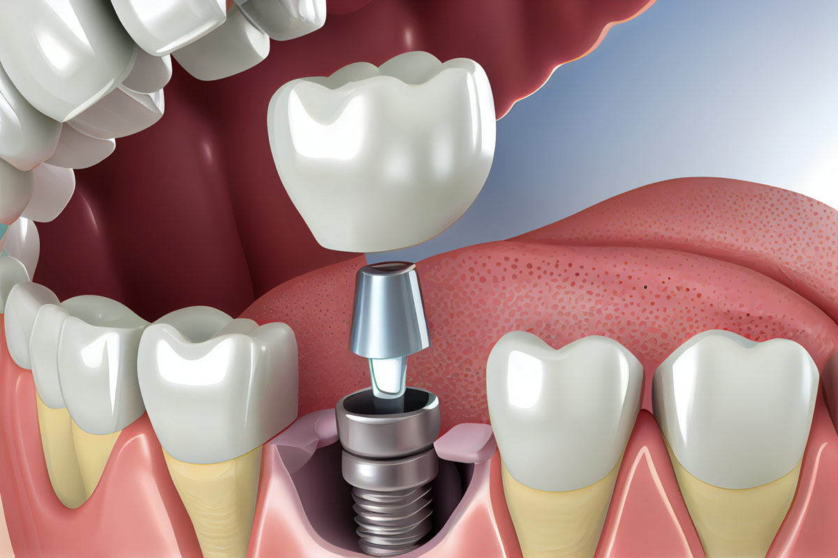 Dental Implants - TRI-STATE DENTAL